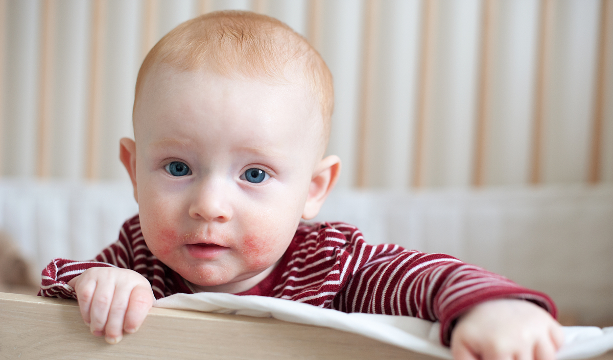 Neurodermitis: Häufigste Hauterkrankung im Kindesalter | CredoWeb