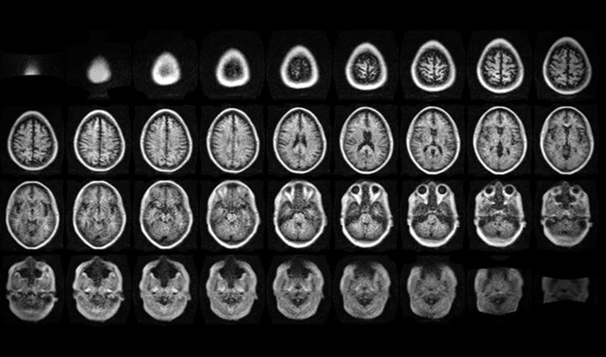 Portable MRI brings brain imaging to the patient bedside | CredoWeb