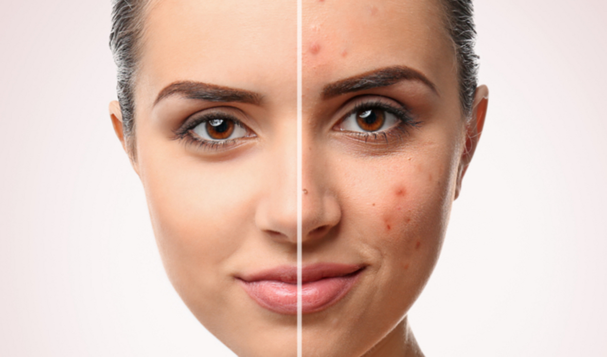 Introduction of a novel therapeutic option for atrophic acne scars ...