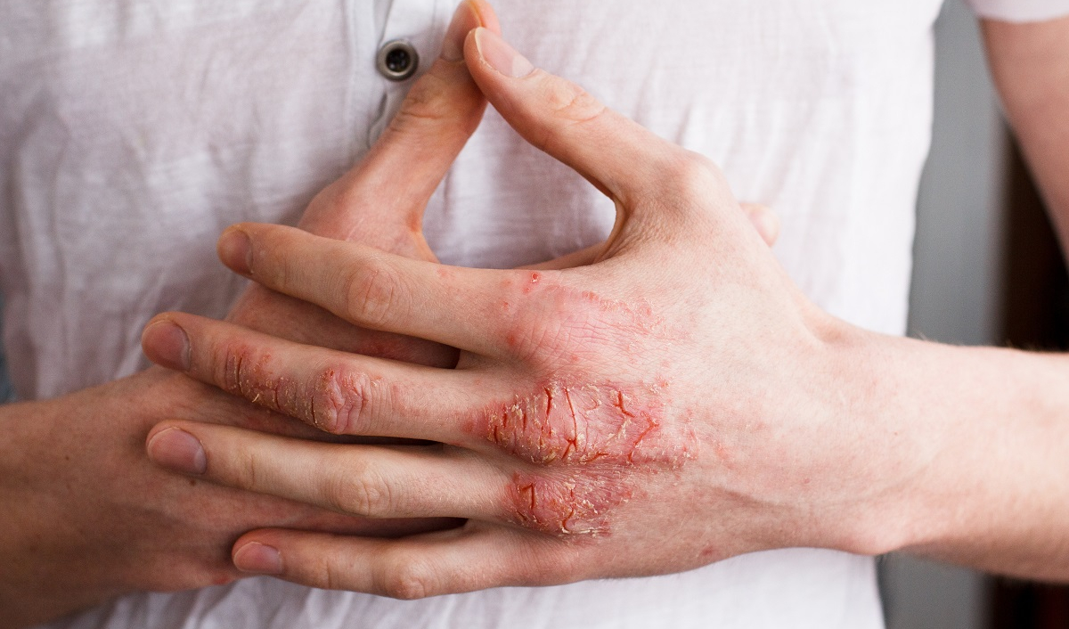 Psoriasis: In a War with Your Own Skin | CredoWeb